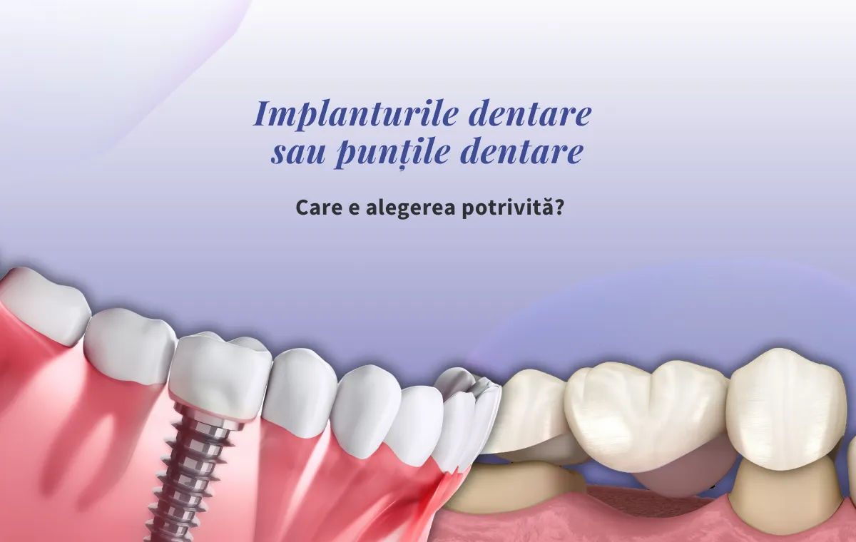 Implanturile dentare sau punțile dentare: Ce alegem?
